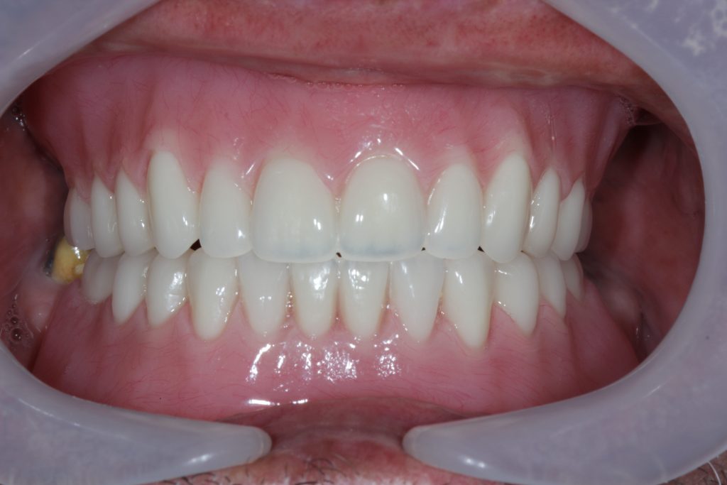 Dentures - R Dental Clinic