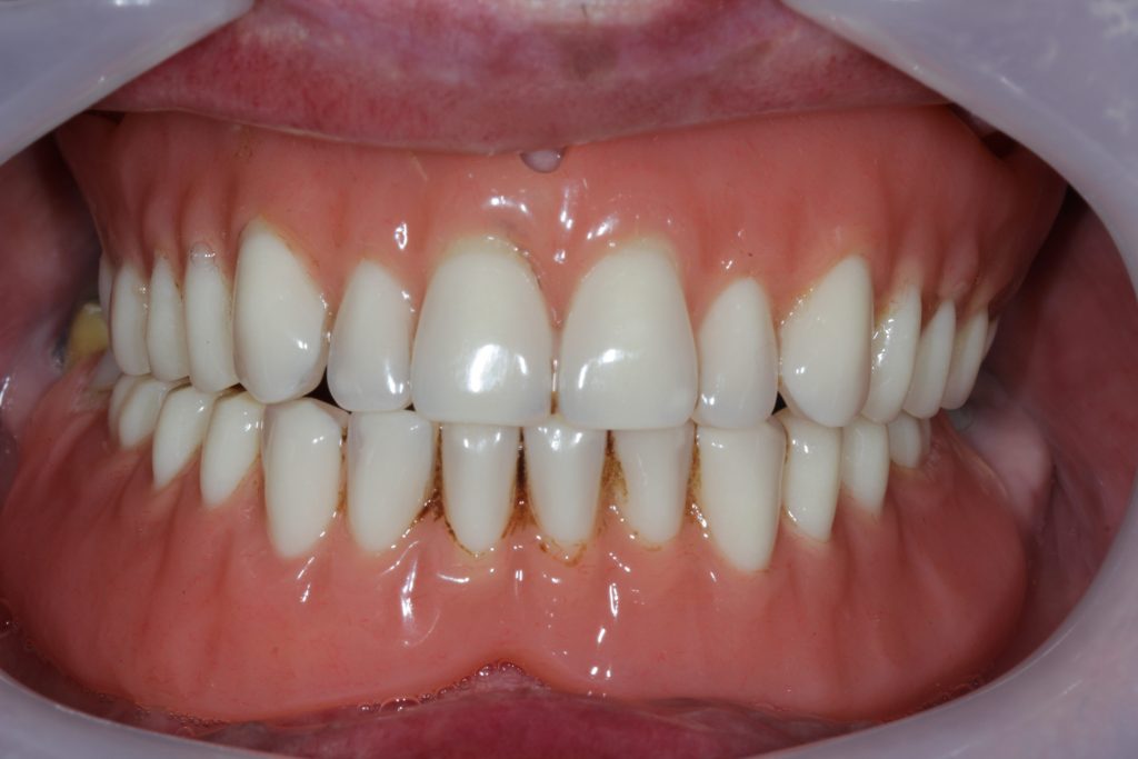 Dentures - R Dental Clinic